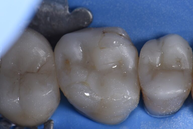 All ceramic crown solutions for heavily-restored teeth
