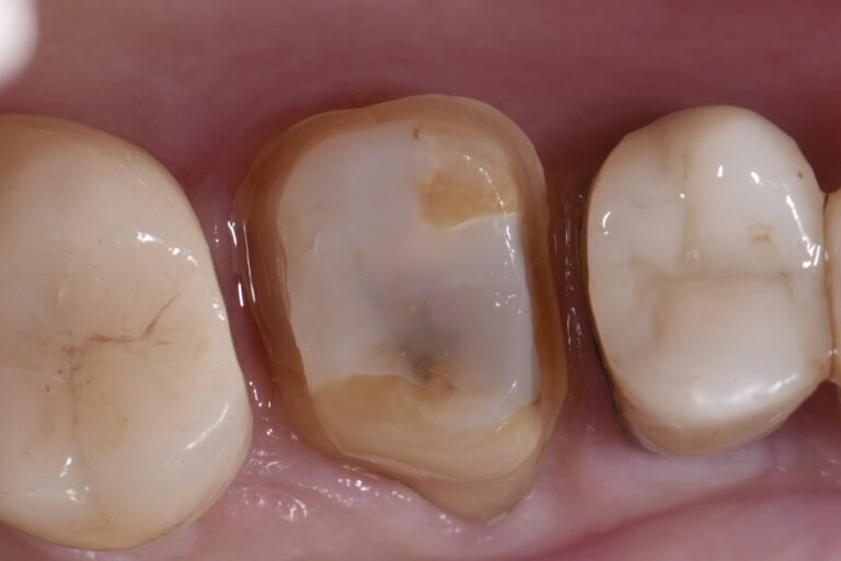 All ceramic crown solutions for heavily-restored teeth