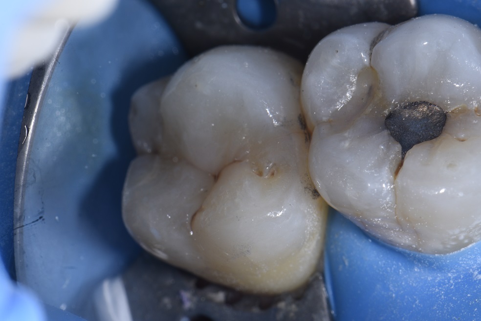 Amalgam replacement with beautifully skulpted resin