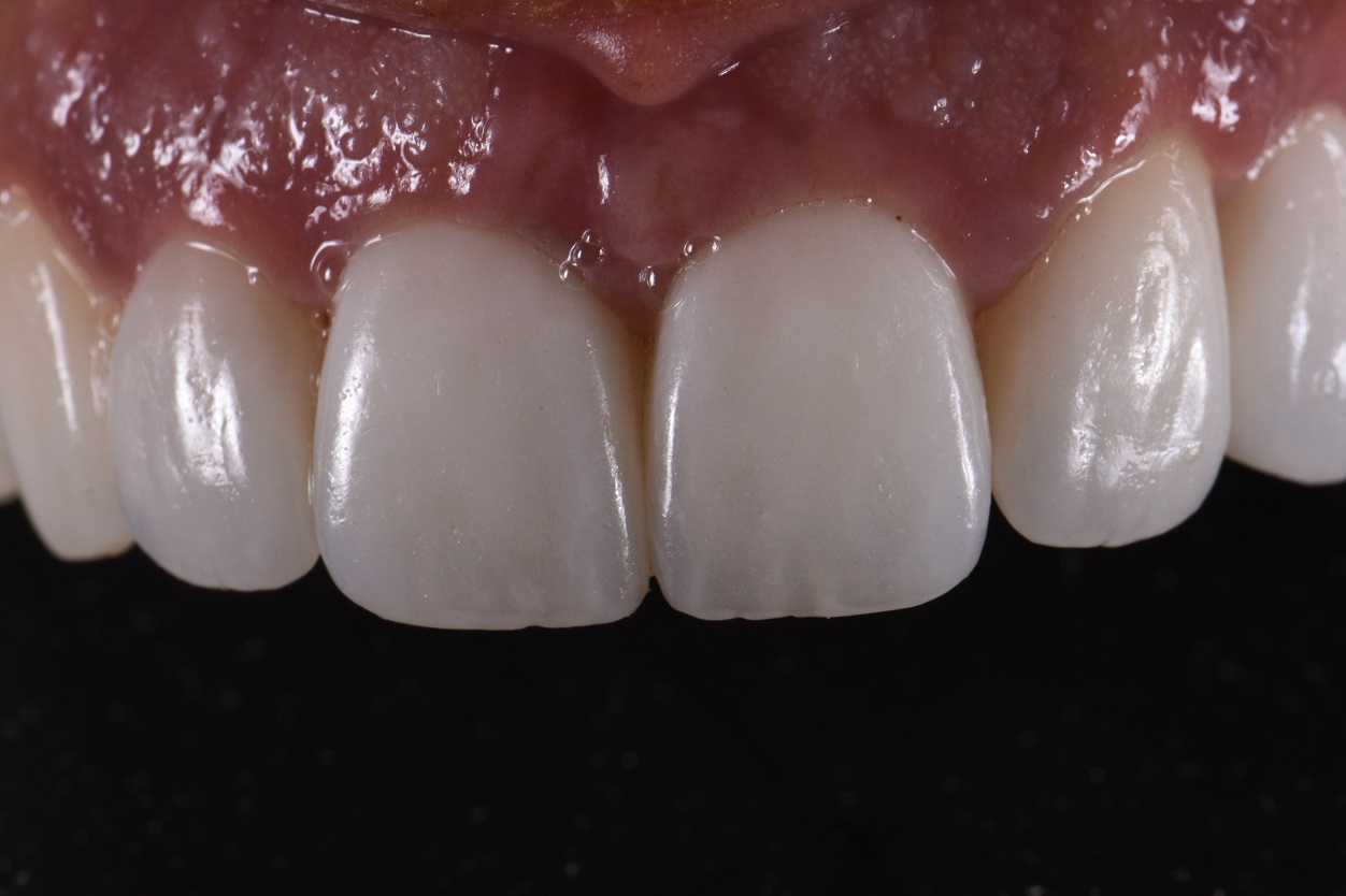 Smile Design with an Implant Supported Crown