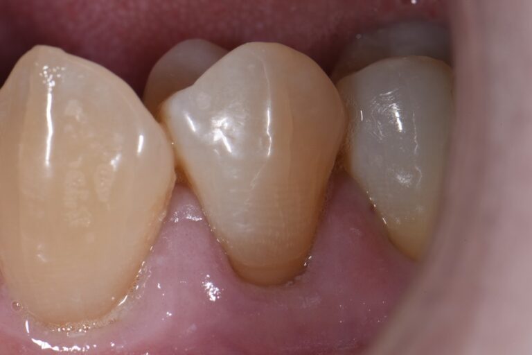 Small Sensitive Root Abrasion Lesions