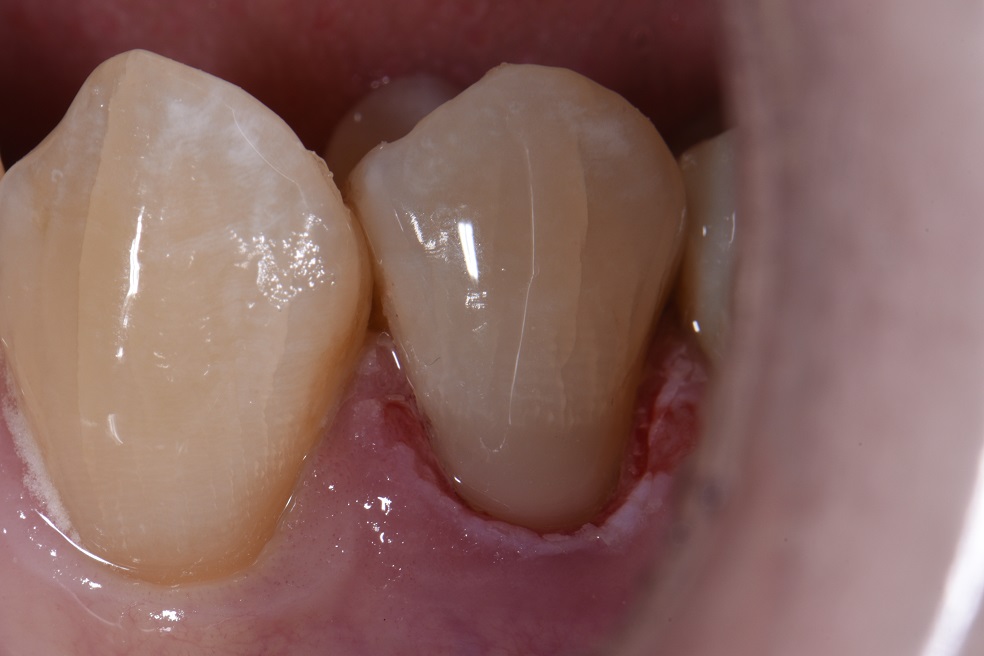 Small Sensitive Root Abrasion Lesions