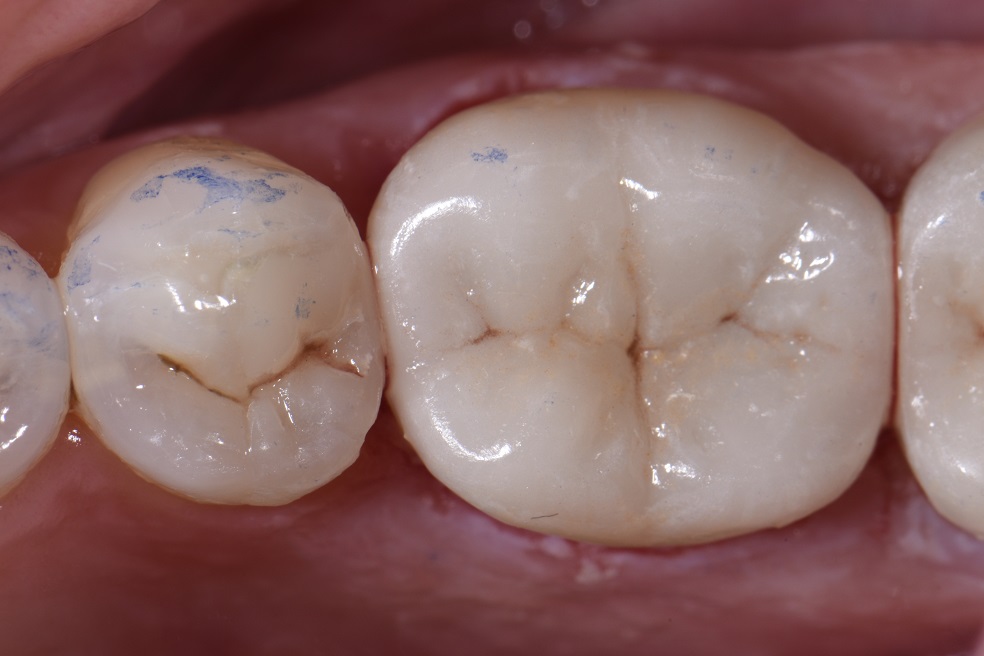 Supporting Cracked Teeth with Minimally Invasive Bonded Crowns