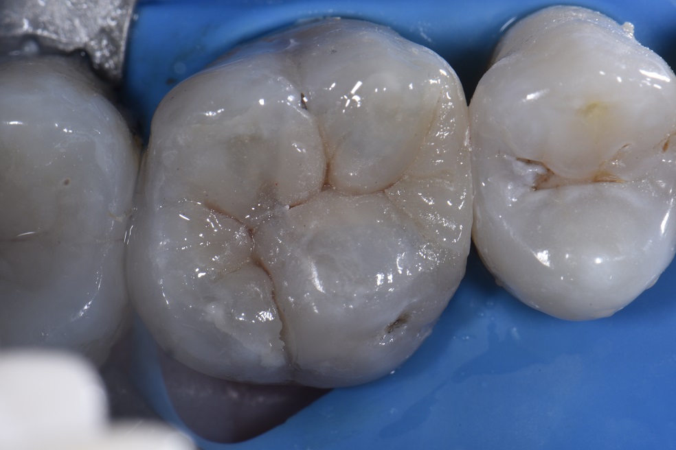 Replacing old amalgams with Beautifil II LS Giomer composite restorative
