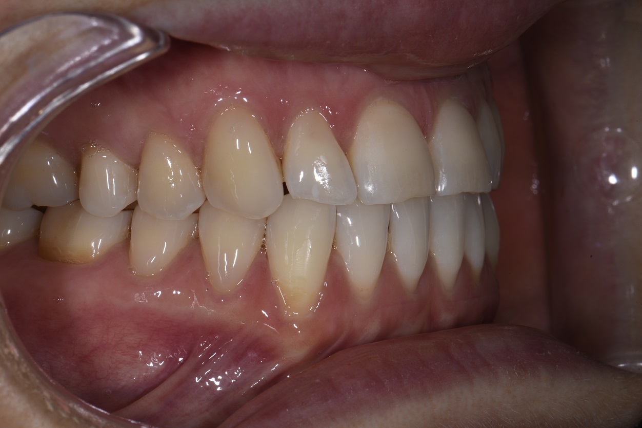 Pre-prosthetic orthodontics opens up possibilities