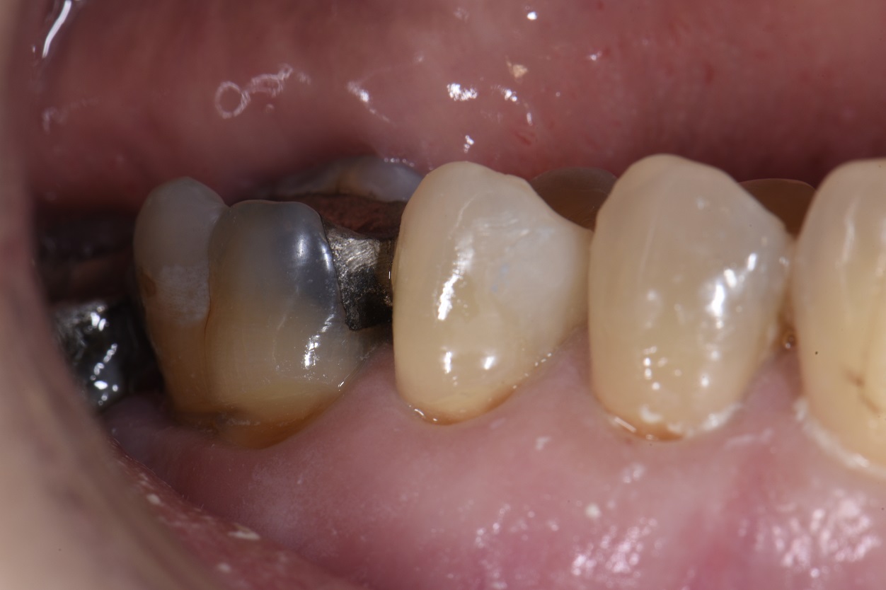 Multiple deep root scrubbing lesions restored invisibly