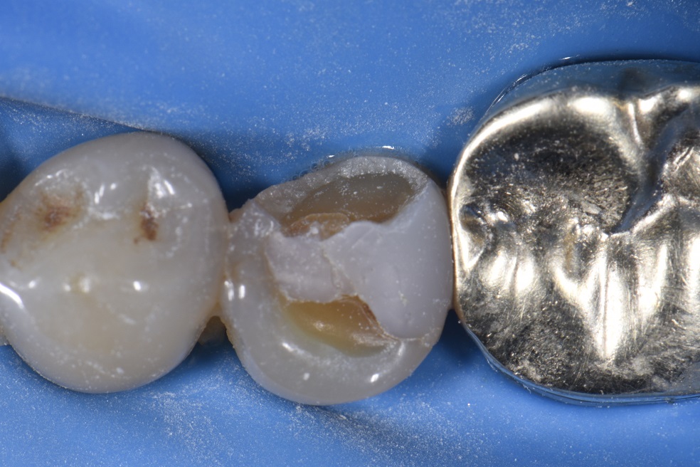 Composite Onlays for Conservation of Tooth Structure