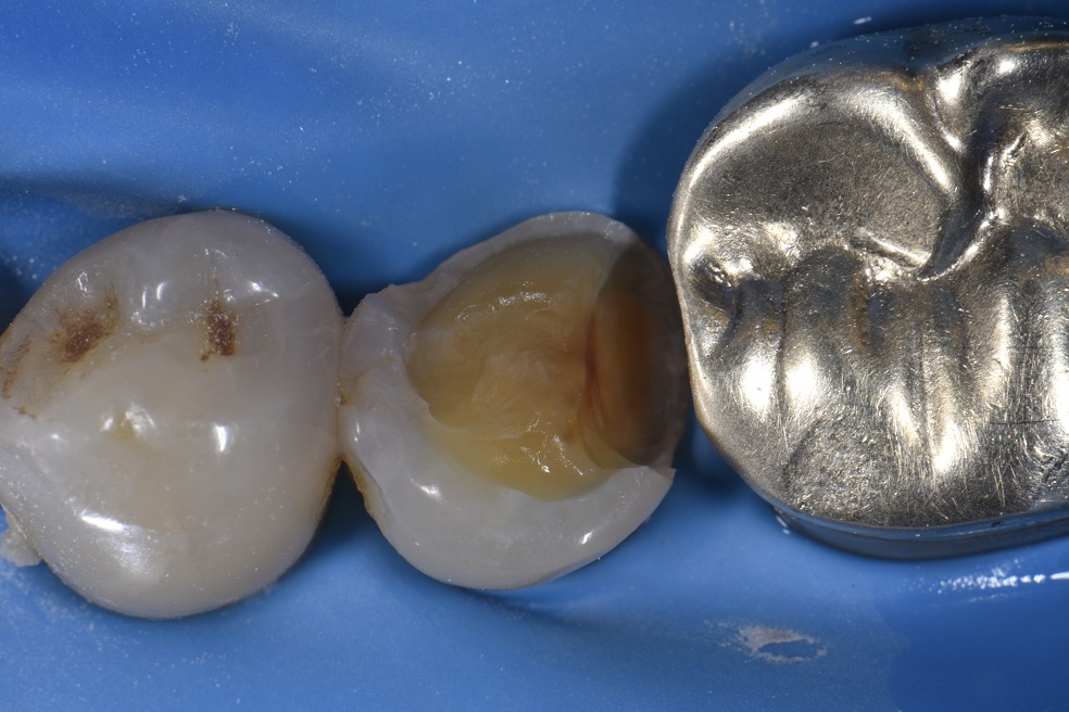 Composite Onlays for Conservation of Tooth Structure