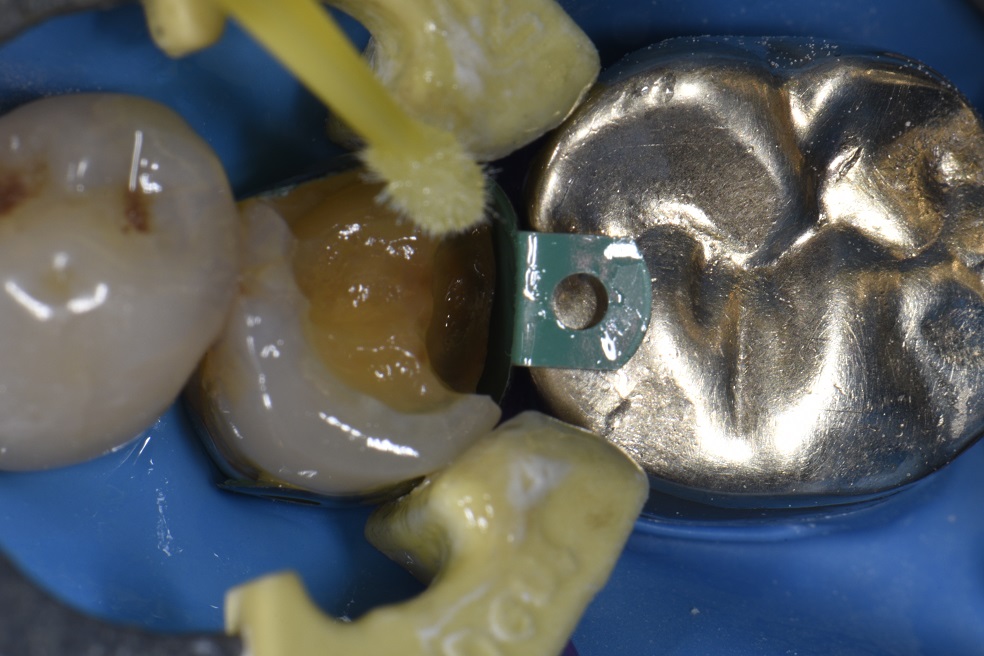 Composite Onlays for Conservation of Tooth Structure