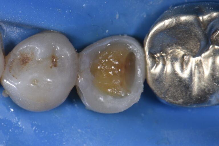 Composite Onlays for Conservation of Tooth Structure