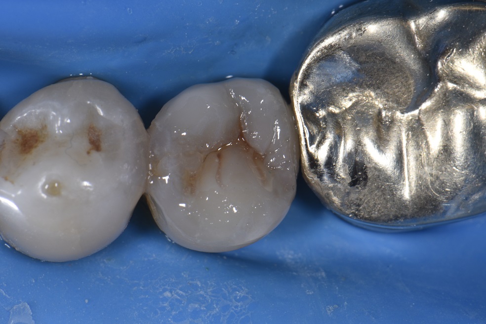Composite Onlays for Conservation of Tooth Structure