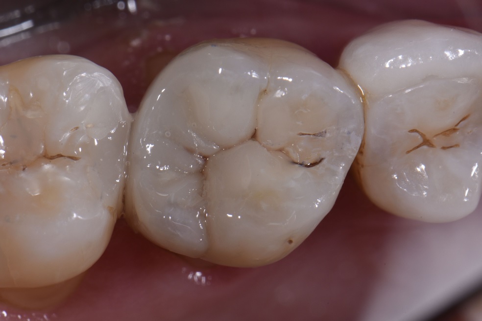 Chasing Nature's Beauty with Composite Resin Bonding