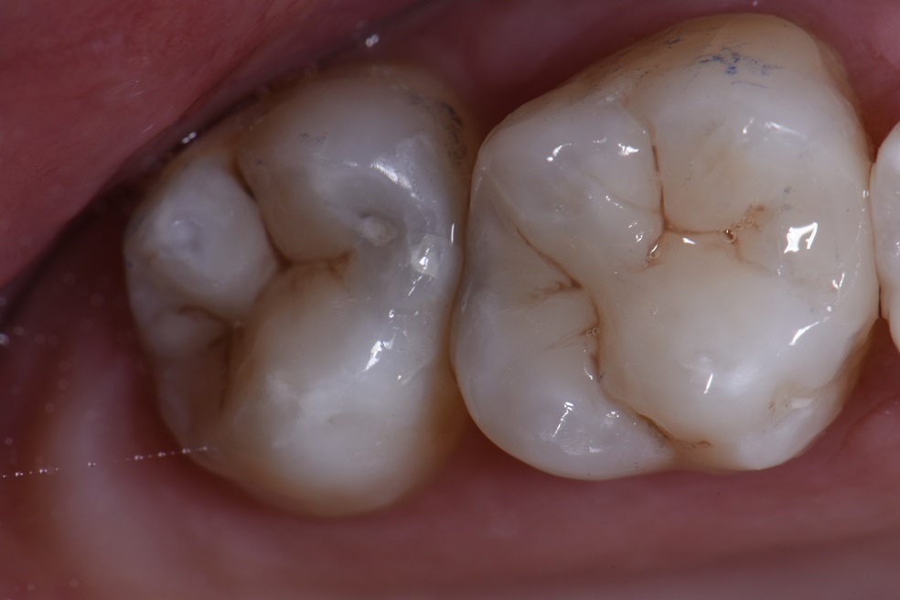 Caries and Amalgams removed and replaced with supercomposite