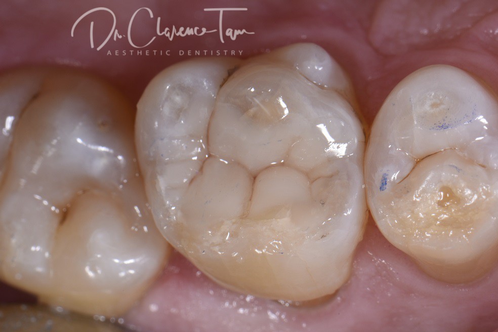 Supercomposite replacement to support cracked amalgam filled teeth