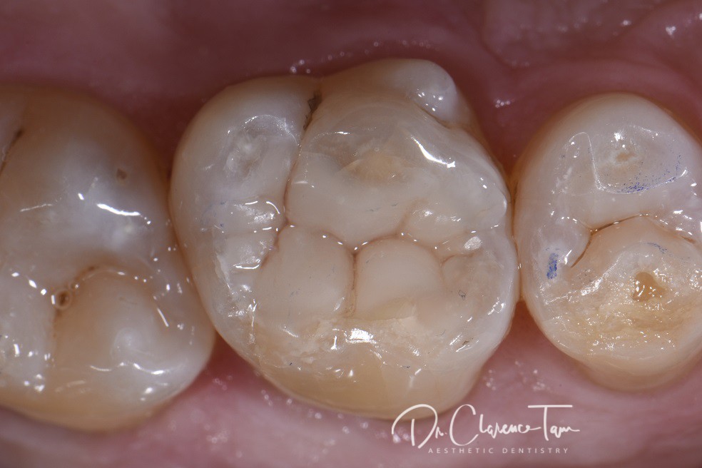 Supercomposite replacement to support cracked amalgam filled teeth