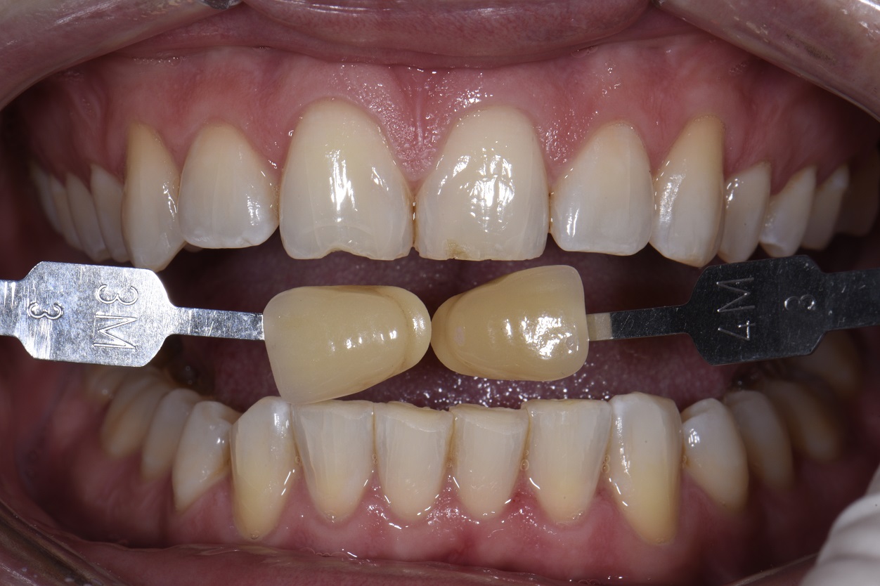 Tooth Whitening Predictability to Lift Confidence