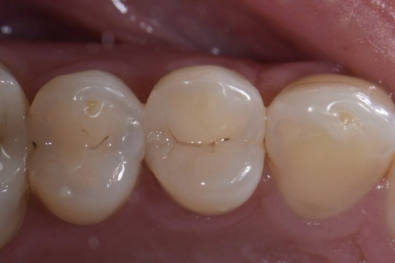 Cavities between the teeth restored like natural teeth
