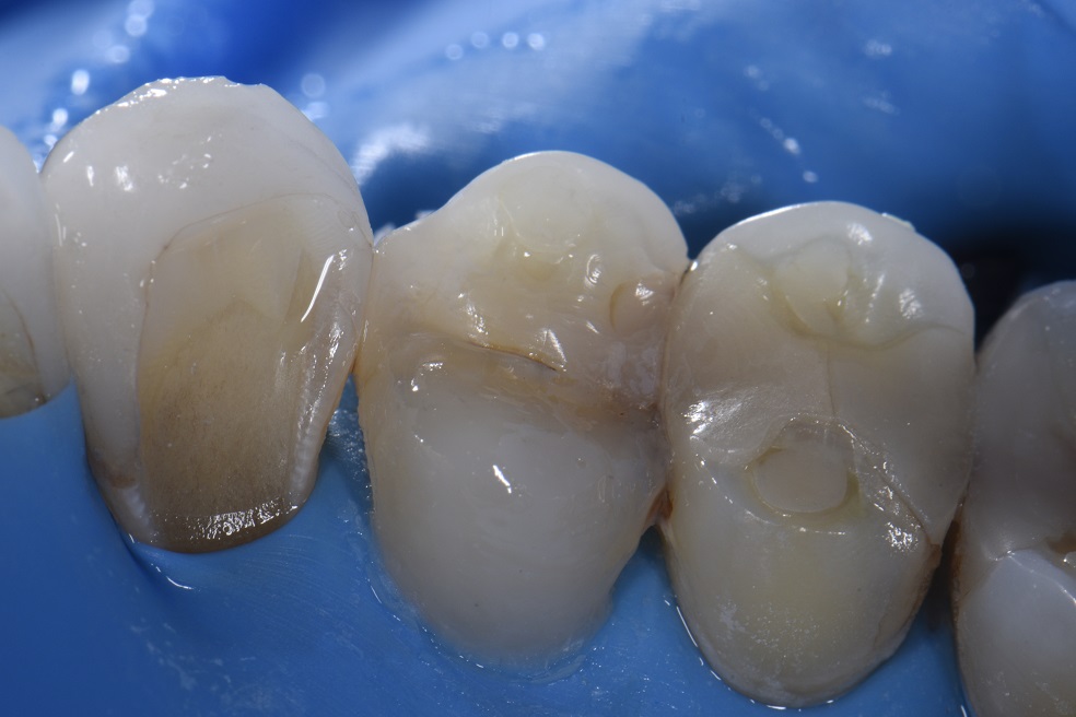 Acid Damage Reversed with a Supercomposite