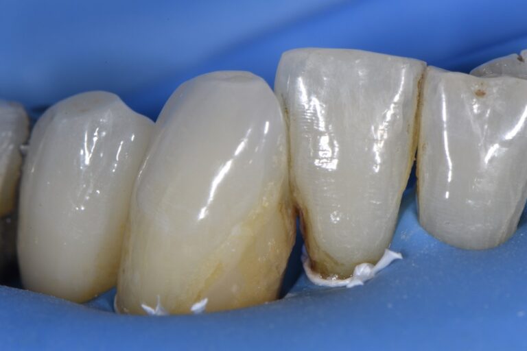 Subgingival root cavities restored with full isolation