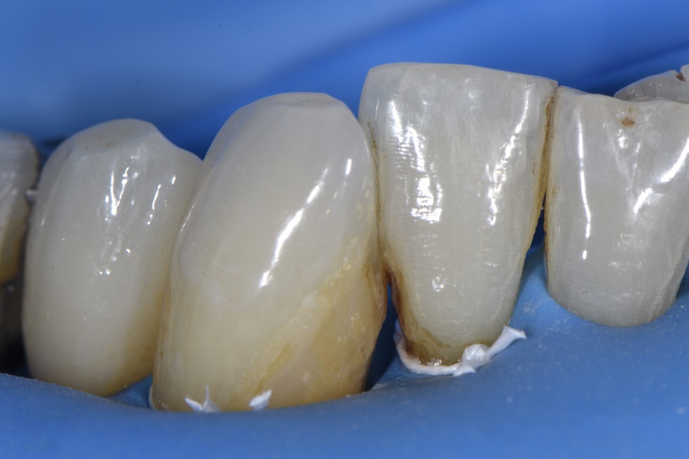Subgingival root cavities restored with full isolation
