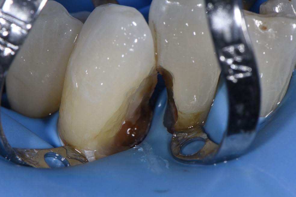 Subgingival root cavities restored with full isolation