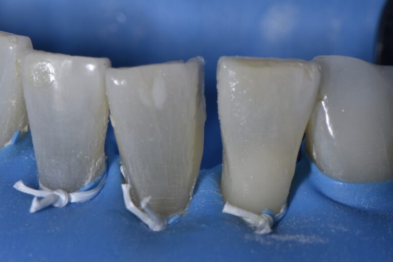 Large Diastema Closure with Composite Resin