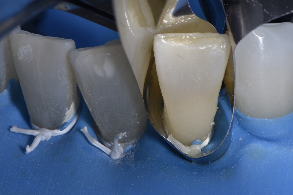 Large Diastema Closure with Composite Resin