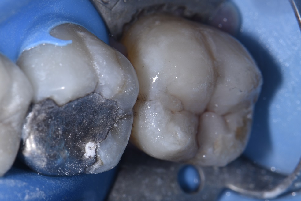 Wisdom Tooth Restorations with Skulpted Composite