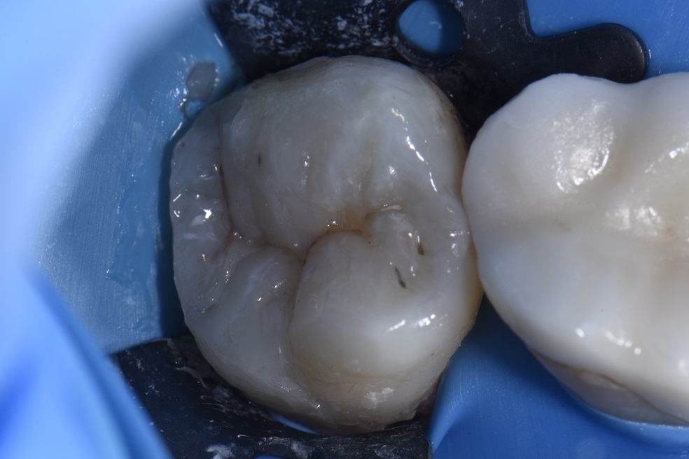 Rebuilding half a tooth with direct composite resin skulpting