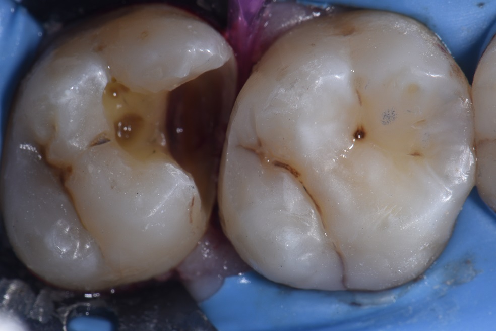 Large back to back cavities restored with nature mimicking restorations