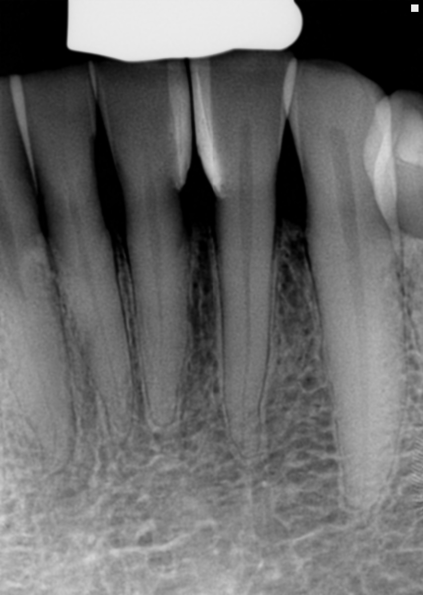 Large Diastema Closure with Composite Resin
