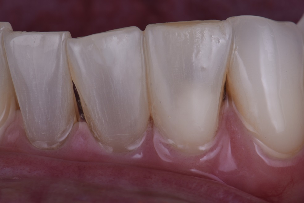 Closing large gaps between teeth with composite resin artistry Closing large gaps between teeth with composite resin artistry