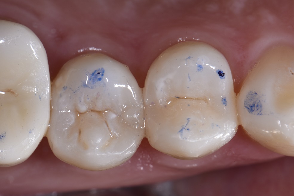 Back to back cavities restored invisibly