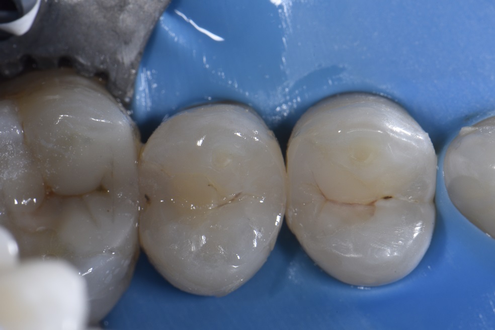 Slot prep cavity removal with a supercomposite resin