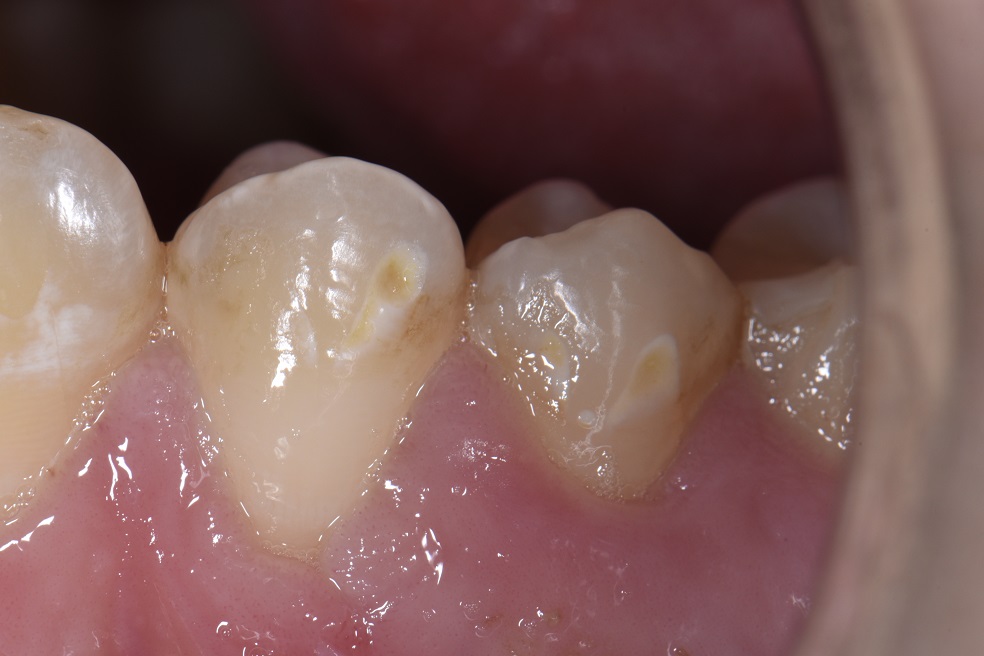 Deficient Enamel Regions Restored Invisibly with Composite Resin