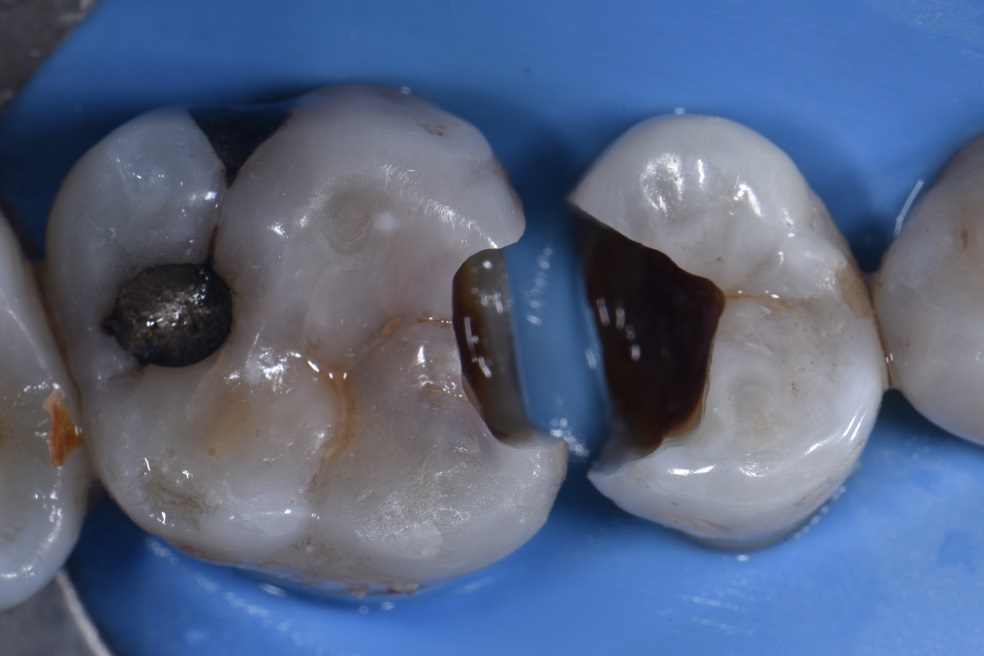 Restoration of Extremely Deep Cavities with Beautiful Composite Resin