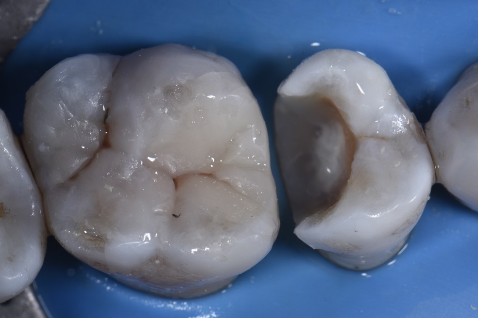 Restoration of Extremely Deep Cavities with Beautiful Composite Resin
