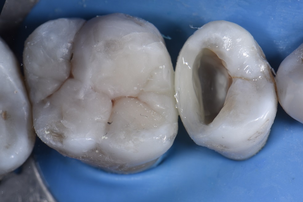 Restoration of Extremely Deep Cavities with Beautiful Composite Resin