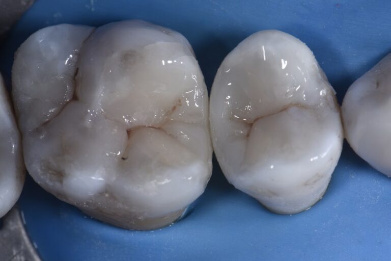 Restoration of Extremely Deep Cavities with Beautiful Composite Resin