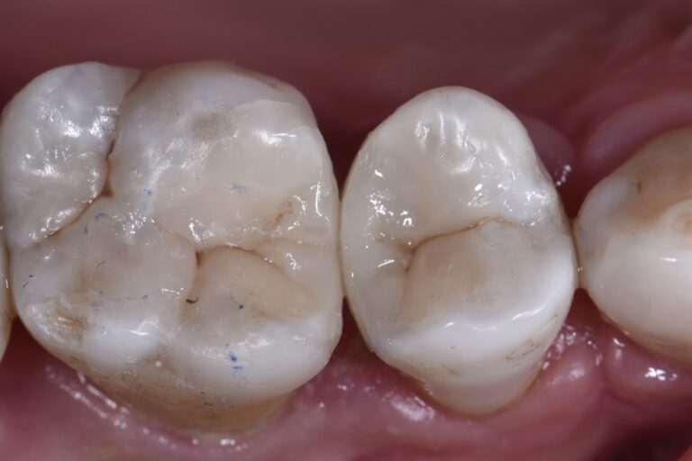 Restoration of Extremely Deep Cavities with Beautiful Composite Resin
