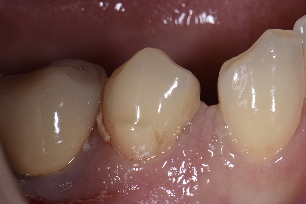 Class V restoration with GC Essentia U