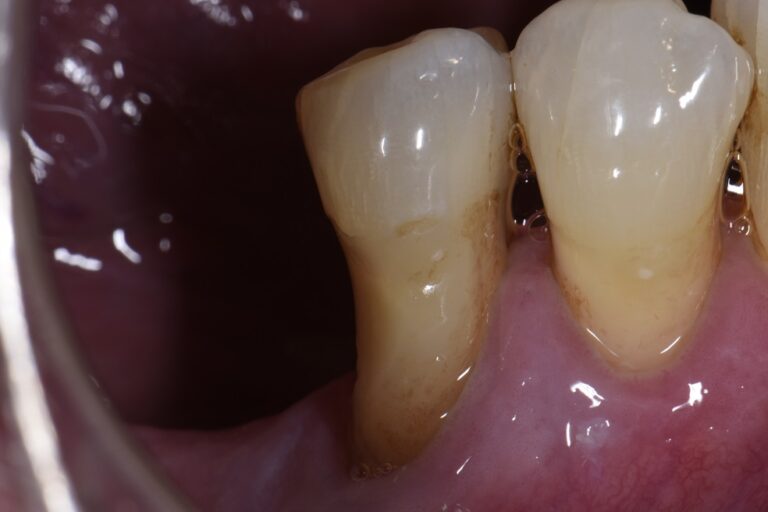 Root insulation restorations to minimize sensitivity