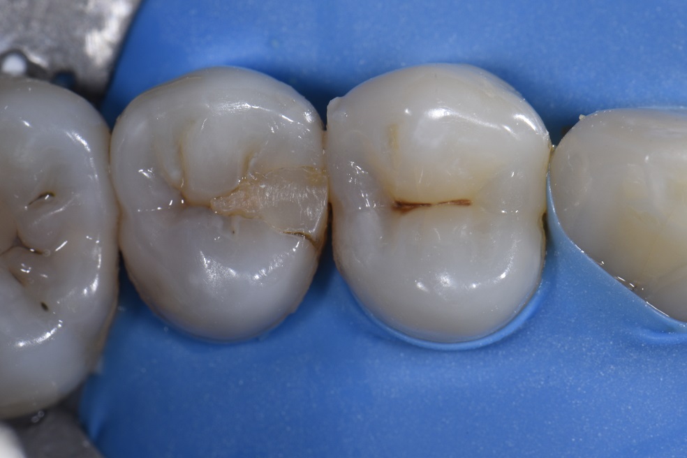 Restoring bombed out carious premolars biomimetically