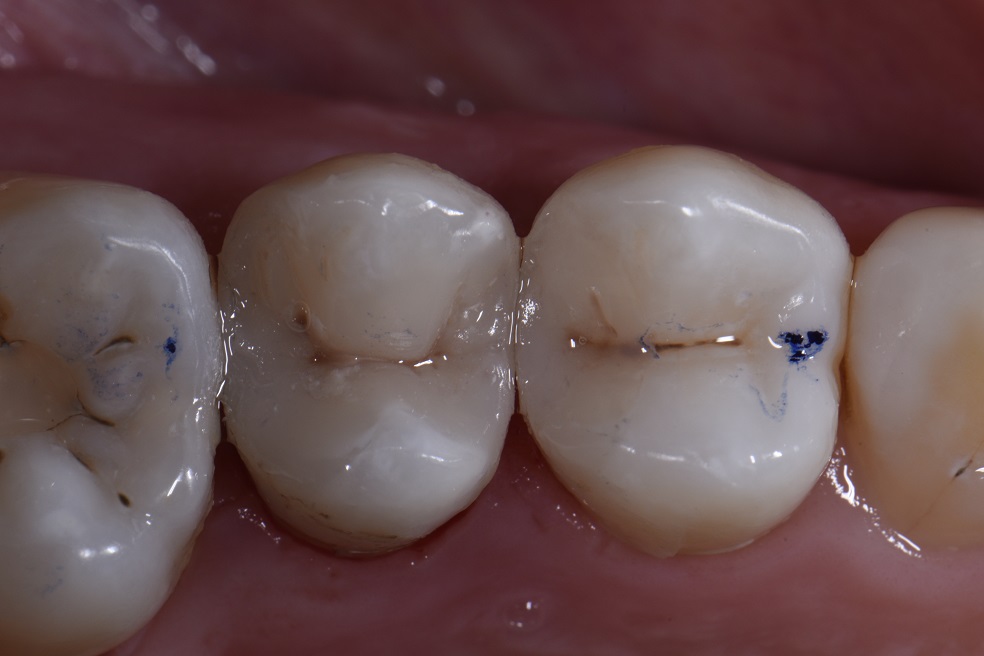 Restoring bombed out carious premolars biomimetically