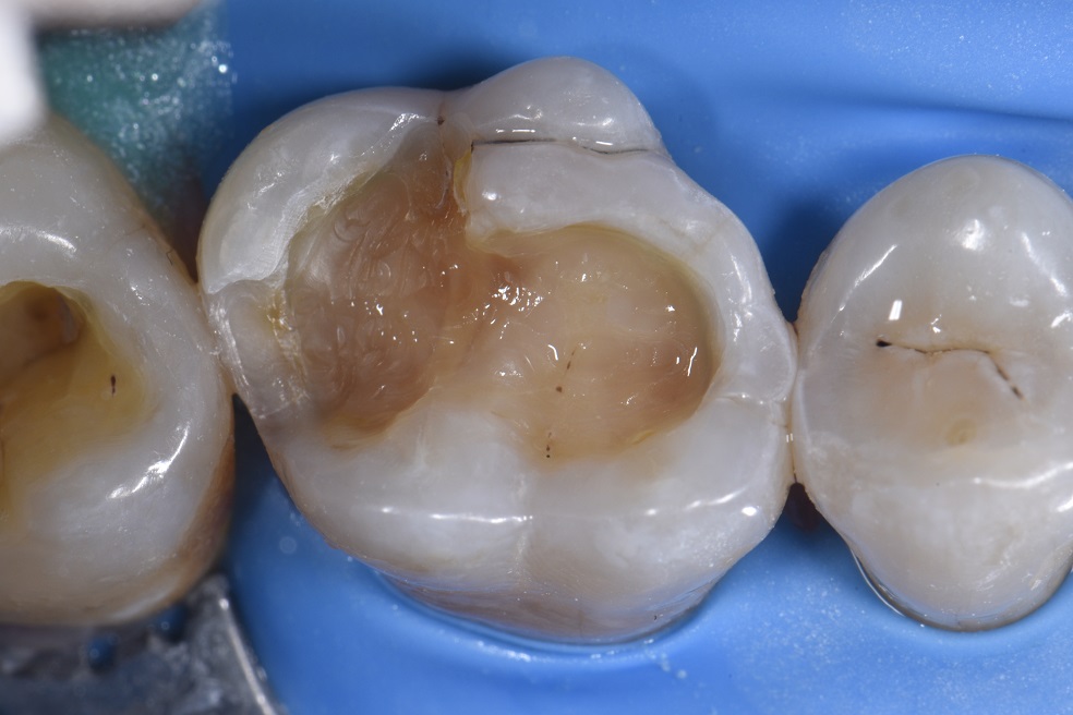 Large composites restorations with Voco Grandio SO