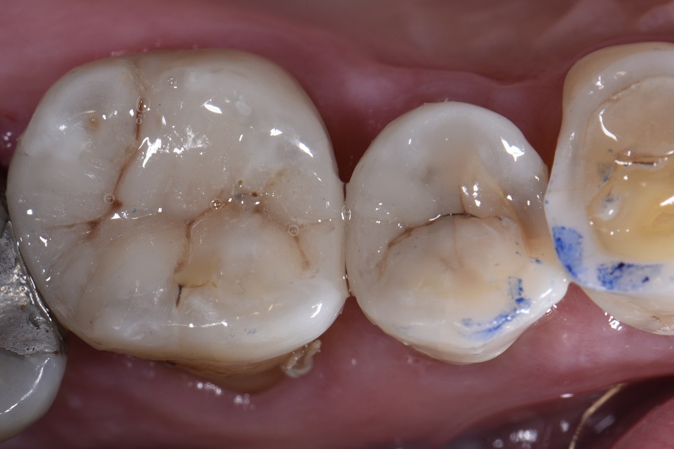 Restoring heavily-filled amalgam teeth with biomimetic fillings