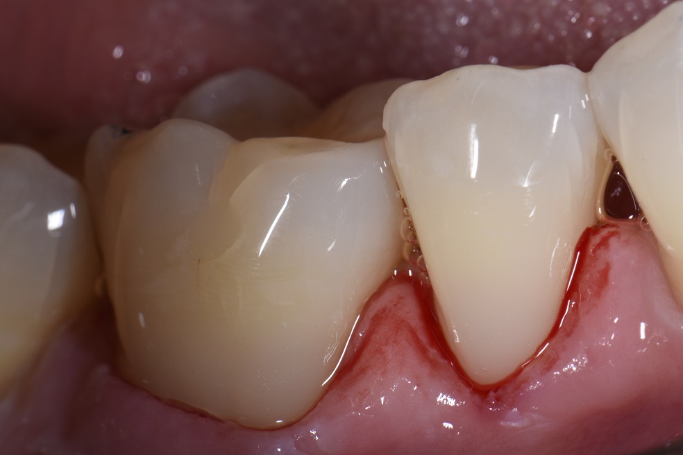 Sensitive roots with abrasion lesions restored invisibly