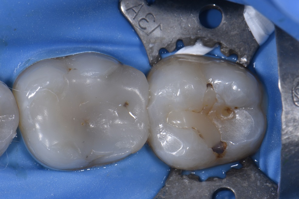 Conserving Tooth Structure during Direct and Indirect Restorative