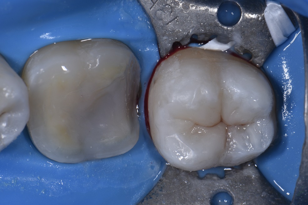 Conserving Tooth Structure during Direct and Indirect Restorative