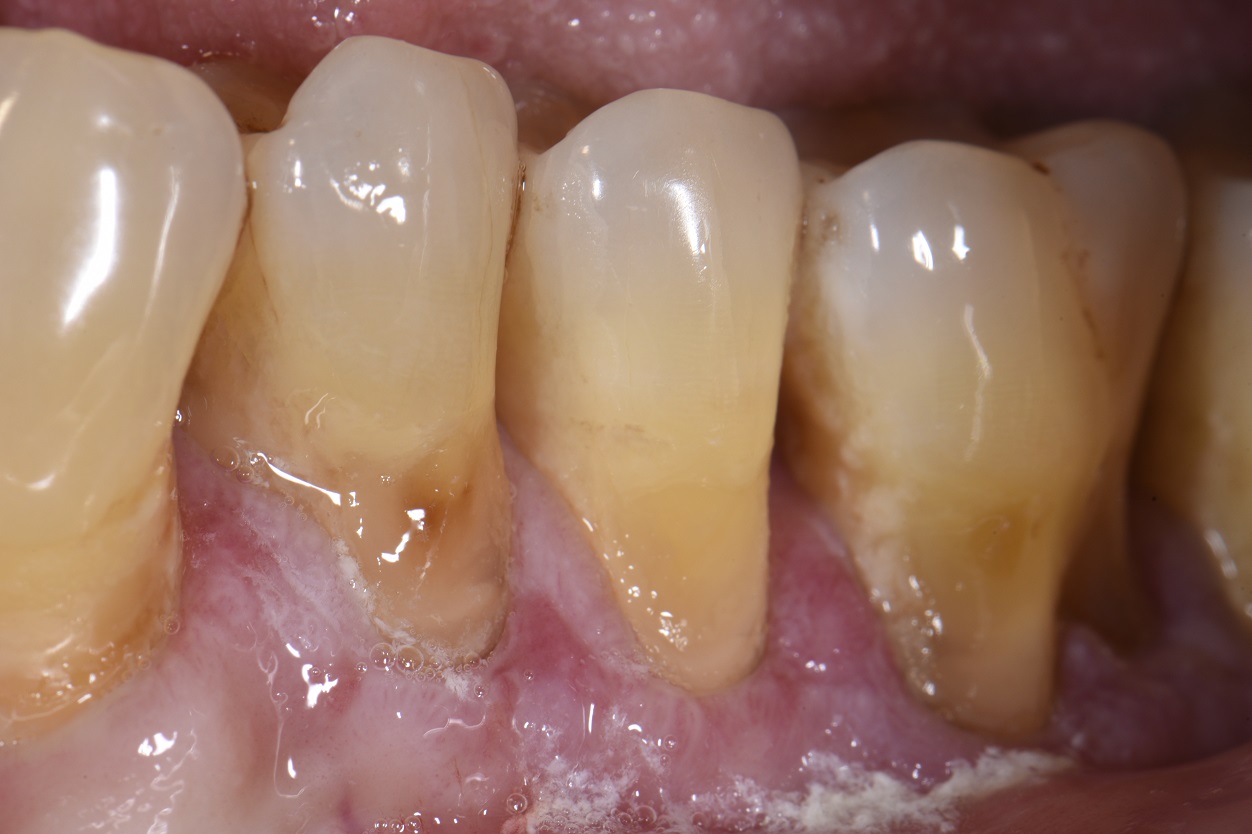 Extensive root abrasion restored biomimetically